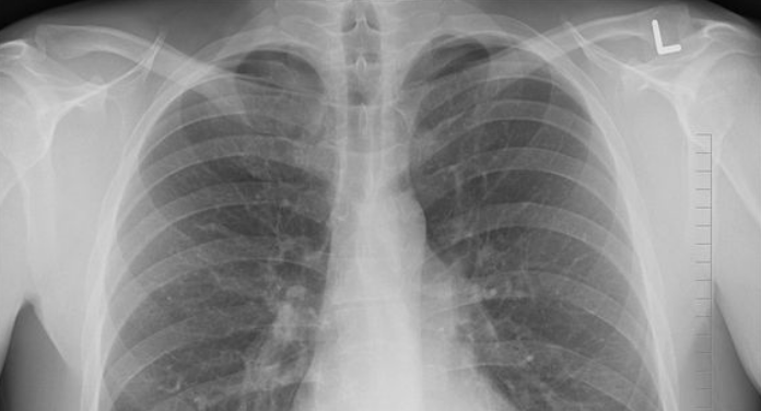 CDC Updates TB Testing Guidelines For Health Care Workers Consultant360 cdc-updates-tb-testing-guidelines-for-health-care-workers-consultant360